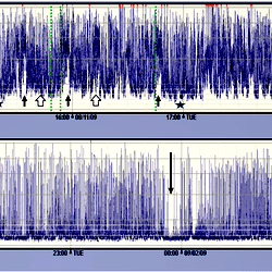 Patterns of aEEG recordings.