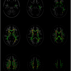 The tract-based spatial statistics (TBSS).