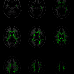 The tract-based spatial statistics (TBSS).