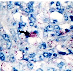 Fite-Faraco staining of skin biopsy demonstrating abundant acid-fast ...