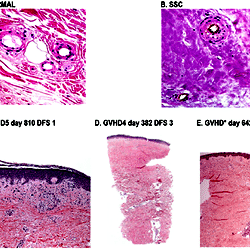 Dermal fibrosis in skin biopsies of Normal, c-GVHD and SSc skin.