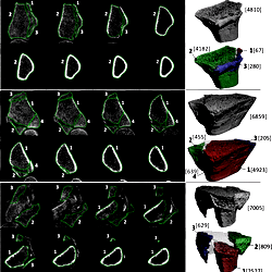 Three fracture cases.