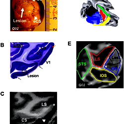 Characterization of the V1 Lesion.