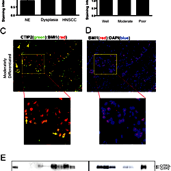 Staining intensities of CTIP2 by immuno-histochemistry in HNSCC.
