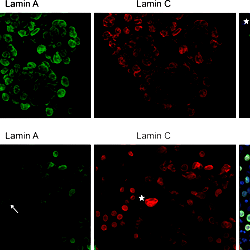 Immunofluorescence staining of lamins A and C in cells from metastatic ...