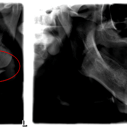 Image of real patient x-ray data suffering from a mandibular angle ...