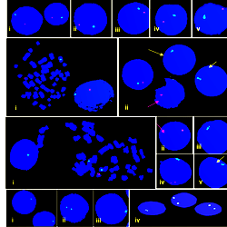 Fluorescence in-situ hybridization (FISH) using LSI SRY probe from VYSIS