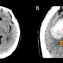 Illustration of CT blend sign.