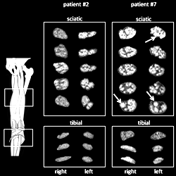 Nerve appearance in T2-w at thigh and calf level.