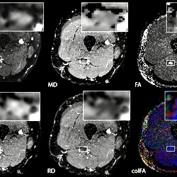 DTI nerve appearance at thigh level.