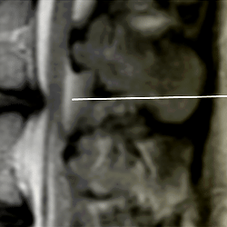 Protrusion type of disk herniation.