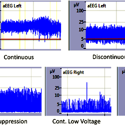 Examples of aEEG background patterns.