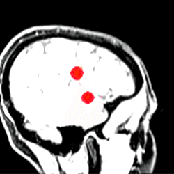 This figure shows the two TMS locations that are targeted in the ...