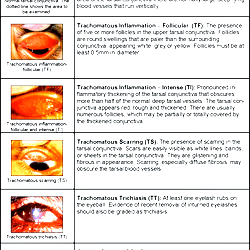 The WHO simplified grading scheme for assessment of trachoma.