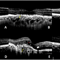 Optical coherence tomography (OCT) images show examples of lesions in ...