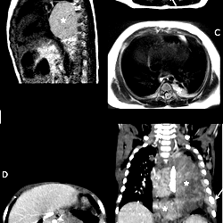 Imaging phenotypes of chest neuroblastomas.