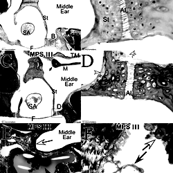 Middle ear pathology.