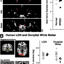 Visual Brain Anatomy in Human LCA from RPE65 Mutations