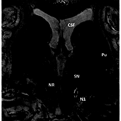 SWI 7T MRI of the midbrain and the surrounding structures.