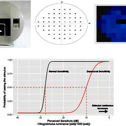 Perimetry testing and visual field.