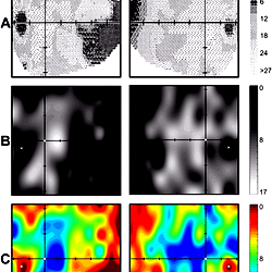 Glaucomatous patient no. 4; Medmont M700 (MM700) and Specvis visual ...