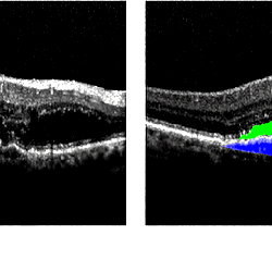 Intraretinal, subretinal and sub-RPE fluid types.