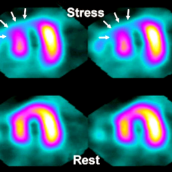 Radionuclide Imaging Showing a Reversible Perfusion Defect in the Septum