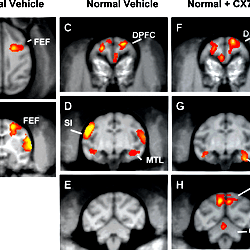 SPM Maps of Brain Regions Showing Changes in Regional CMRglc during ...