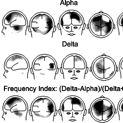 Correlation Map between Alpha, Delta, and Tinnitus-Related Distress