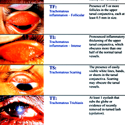 WHO Simplified Grading System: A Guide for the Assessment of Trachoma