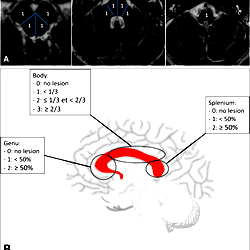 Lesions in deep gray nuclei after severe traumatic brain injury predict ...