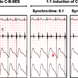 Representative plethysmography waveform charts during C-B-SES without ...