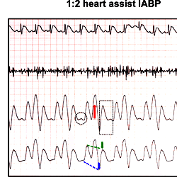 Representative plethysmography waveform chart in an ideal 1:2 heart ...