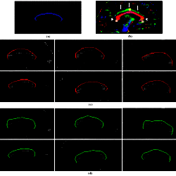 Illustration of 3D skeleton extraction of right cingulum bundle by ...
