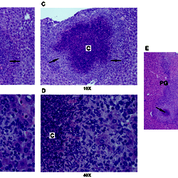 Pyogranulomatous inflammation of liver.