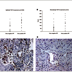 TGF-β expression in IPF lung tissue.