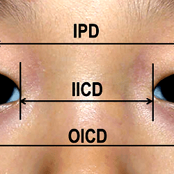 The severity of epicanthus was determined using the inner intercanthal ...