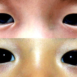 Types of epicanthus.