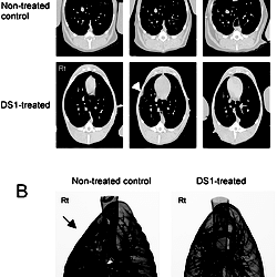 High resolution CT scans of the chest at baseline and then at the ...