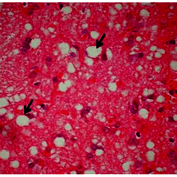 Pathologic image of sCJD.