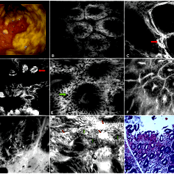 Endoscopic and endomicroscopic appearance of C. difficile infection.