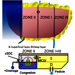 The influence of venous system patterns on DIEP flap viability for ...