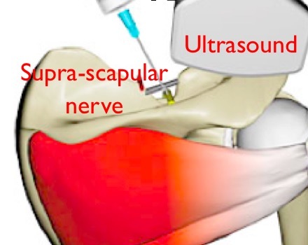 New Developments in the Treatment of Rotator Cuff Disease