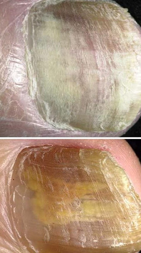 mycose des ongles(onychomycose)